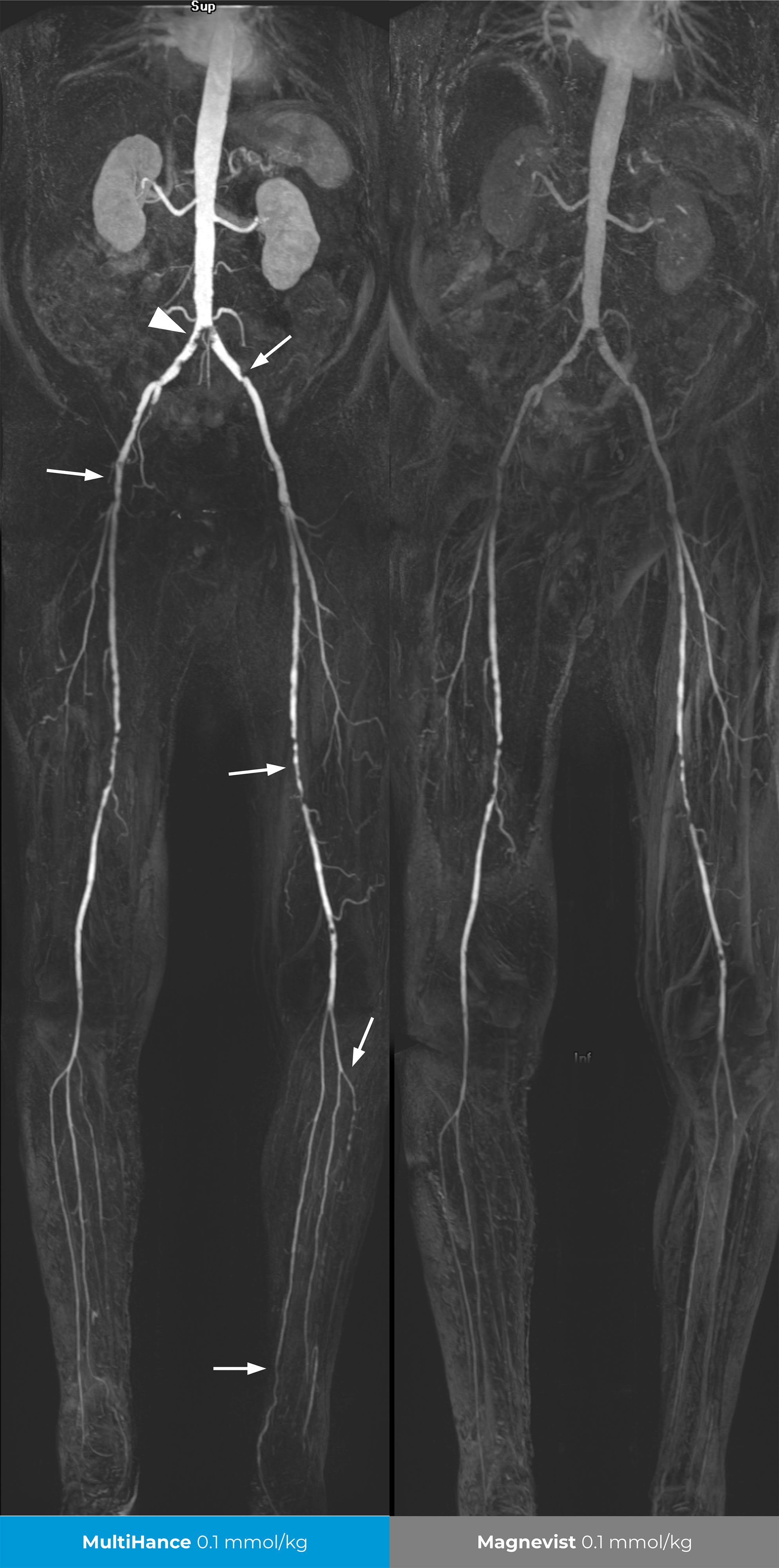 Gerretsen et al. 72M with Moderate Claudication in Right and Left Thigh ...