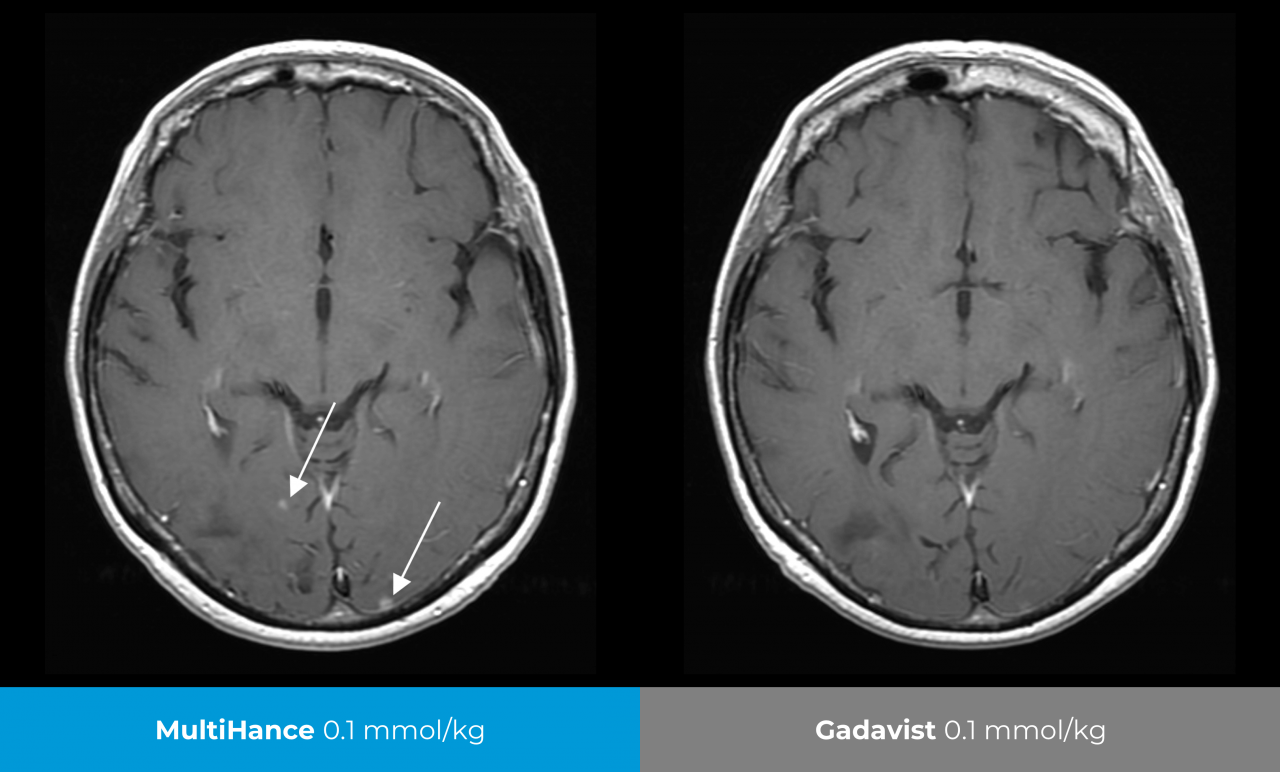 MultiHance - BraccoMR