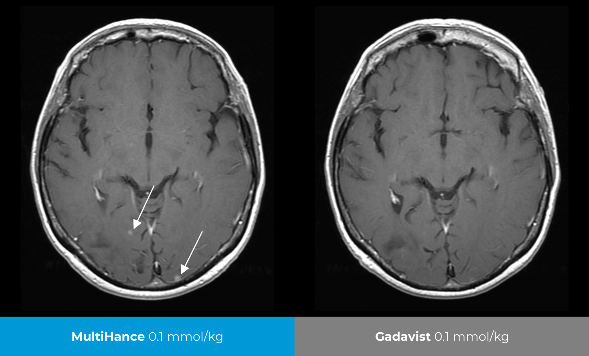 MultiHance - BraccoMR