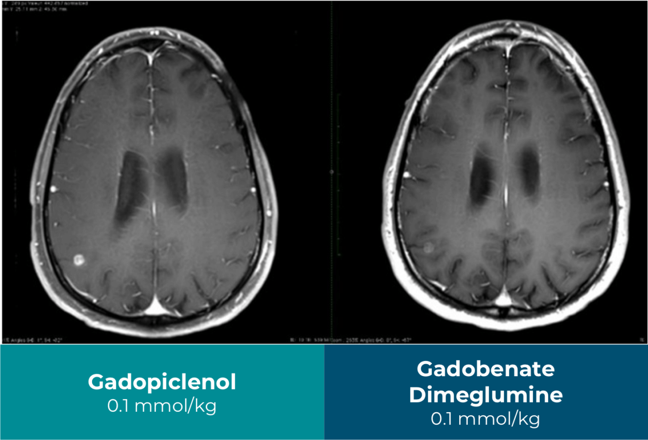Brain Metastasis from Lung Cancer 38M - BraccoMR