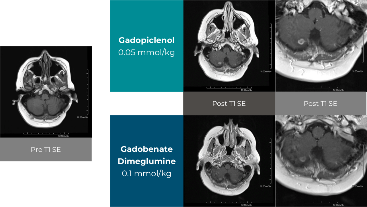 Brain metastasis from lung cancer 63F - BraccoMR