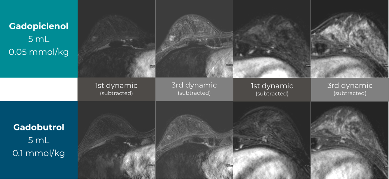 Cancer and Fibroadenoma 34F - BraccoMR